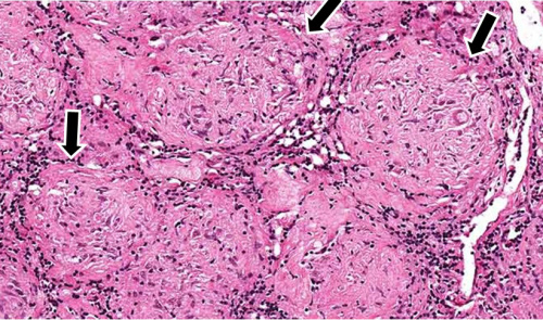 IPLab:Lab 3:Sarcoidosis - Pathology Education Instructional Resource