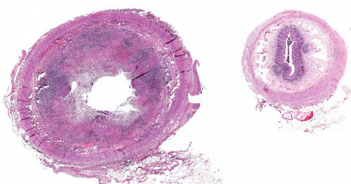 IPLab:Lab 3:Acute Appendicitis - Pathology Education Instructional Resource