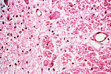 IPLab:Lab 8:Poliomyelitis - Pathology Education Instructional Resource