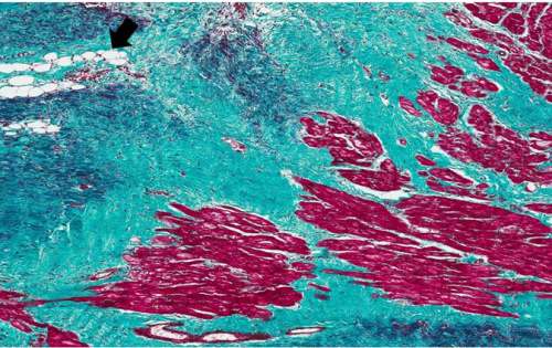 IPLab:Lab 3:Healed Myocardial Infarction - Pathology Education ...