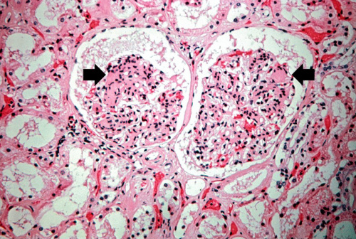 IPLab:Lab 5:Nodular Intercapillary Glomerulosclerosis - Pathology ...