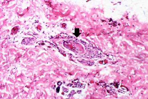 IPLab:Lab 9:RMSF - Pathology Education Instructional Resource