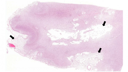 IPLab:Lab 3:Brain Infarction - Pathology Education Instructional Resource