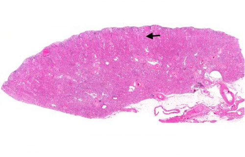 IPLab:Lab 6:Glomerulonephritis - Pathology Education Instructional Resource