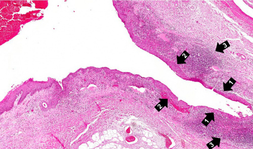IPLab:Lab 2:Metaplasia - Pathology Education Instructional Resource