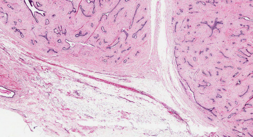 IPLab:Lab 7:Fibroadenoma - Pathology Education Instructional Resource