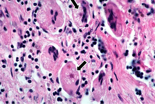 IPLab:Lab 3:Sarcoidosis - Pathology Education Instructional Resource