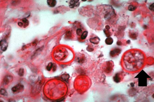 IPLab:Lab 10:Blastomycosis - Pathology Education Instructional Resource