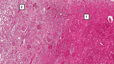 IPLab:Lab 1:Kidney Infarction - Pathology Education Instructional Resource