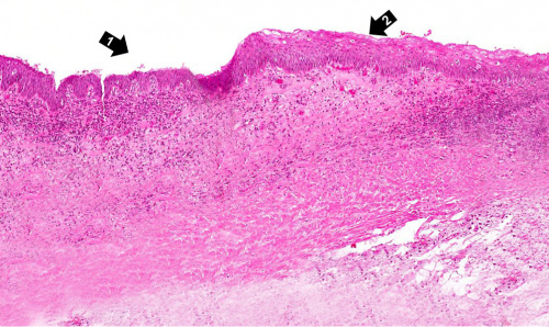 IPLab:Lab 2:Metaplasia - Pathology Education Instructional Resource
