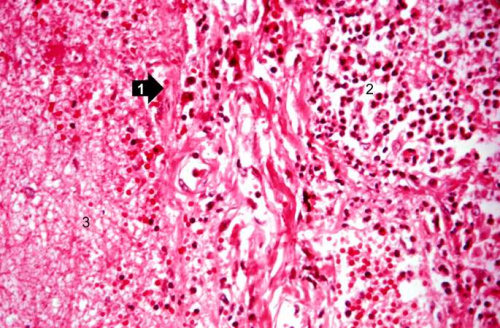 IPLab:Lab 3:Lobar Pneumonia - Pathology Education Instructional Resource