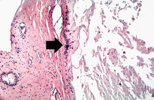 IPLab:Lab 5:Gout - Pathology Education Instructional Resource