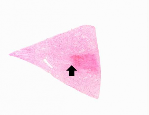 IPLab:Lab 1:Kidney Infarction - Pathology Education Instructional Resource