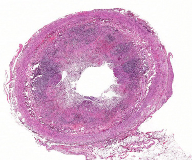 IPLab:Lab 3:Acute Appendicitis - Pathology Education Instructional Resource