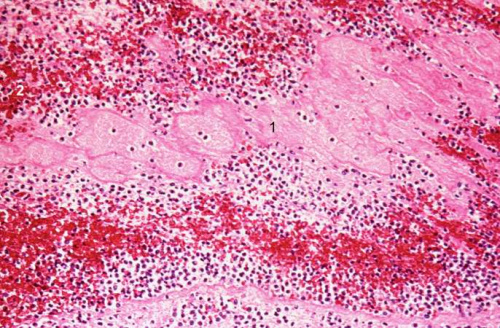 IPLab:Lab 3:Acute Myocardial Infarction - Pathology Education ...