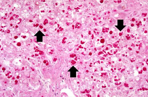 IPLab:Lab 5:α1 Antitrypsin Deficiency - Pathology Education ...
