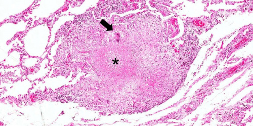 IPLab:Lab 1:Tuberculosis - Pathology Education Instructional Resource