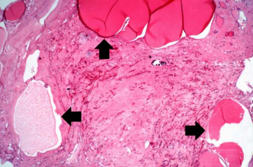 IPLab:Lab 5:Polycystic Kidney Disease - Pathology Education ...