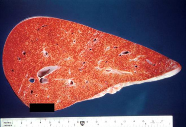 IPLab:Lab 4:Chronic Passive Congestion - Pathology Education ...