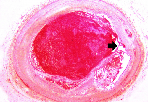 IPLab:Lab 4:Thrombosis - Pathology Education Instructional Resource
