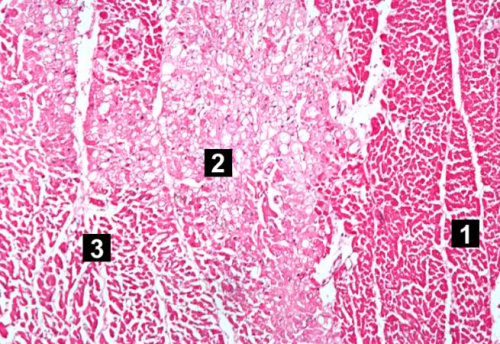 IPLab:Lab 1:Myocardial Infarction - Pathology Education Instructional ...