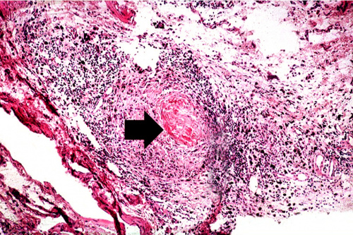 IPLab:Lab 6:Rheumatoid Arthritis - Pathology Education Instructional ...