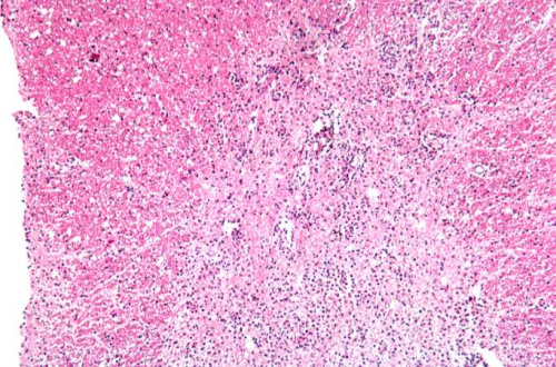 IPLab:Lab 8:Poliomyelitis - Pathology Education Instructional Resource