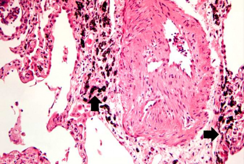 IPLab:Lab 12:Radiation Fibrosis - Pathology Education Instructional ...