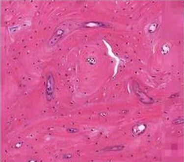 IPLab:Lab 7:Osteosarcoma - Pathology Education Instructional Resource