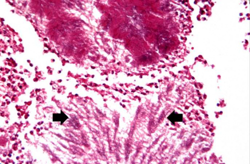 IPLab:Lab 9:Actinomycosis - Pathology Education Instructional Resource
