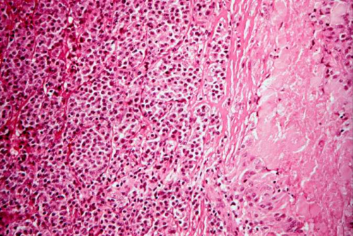 IPLab:Lab 6:Multiple Myeloma - Pathology Education Instructional Resource