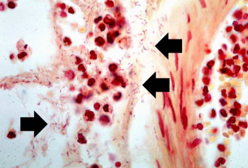 IPLab:Lab 9:Bacterial Meningitis - Pathology Education Instructional ...