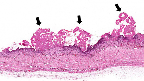 IPLab:Lab 3:Fibrinous Pericarditis - Pathology Education Instructional ...