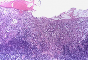 IPLab:Lab 11:Leishmaniasis - Pathology Education Instructional Resource