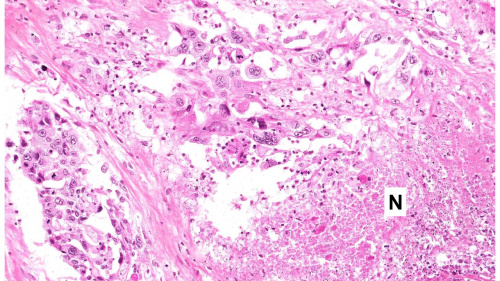 IPLab:Lab 7:Bronchogenic Carcinoma - Pathology Education Instructional ...