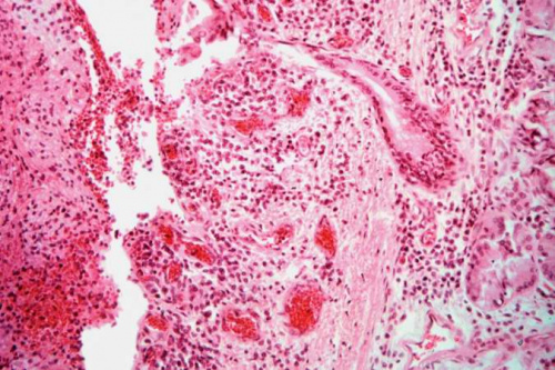 IPLab:Lab 9:Diphtheria - Pathology Education Instructional Resource