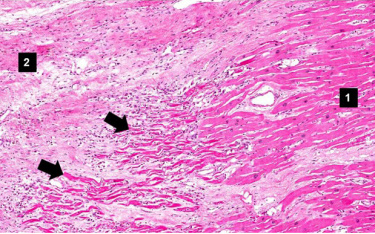 IPLab:Lab 3:Healed Myocardial Infarction - Pathology Education ...