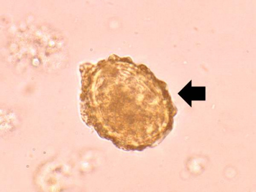 IPLab:Lab 11:Ascariasis - Pathology Education Instructional Resource