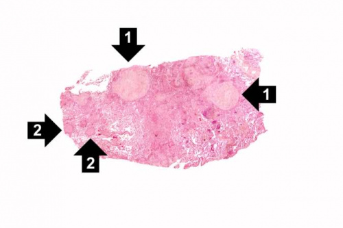 IPLab:Lab 3:Tuberculosis - Pathology Education Instructional Resource
