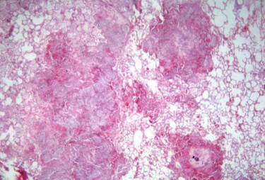 IPLab:Lab 4:Septic Emboli - Pathology Education Instructional Resource