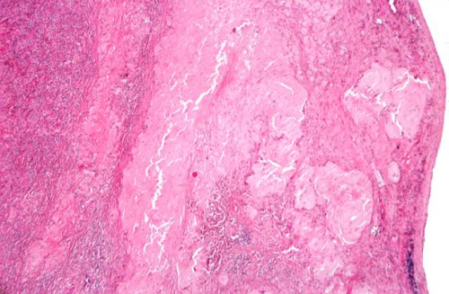 IPLab:Lab 6:Multiple Myeloma - Pathology Education Instructional Resource