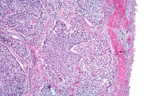 IPLab:Lab 7:Bronchogenic Carcinoma - Pathology Education Instructional ...