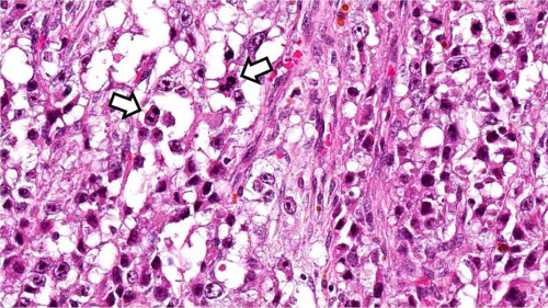 IPLab:Lab 7:Osteosarcoma - Pathology Education Instructional Resource
