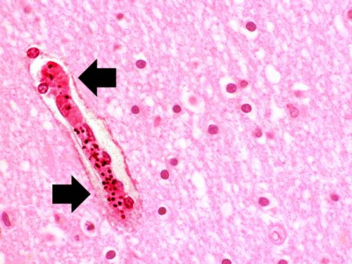 IPLab:Lab 11:Malaria - Pathology Education Instructional Resource
