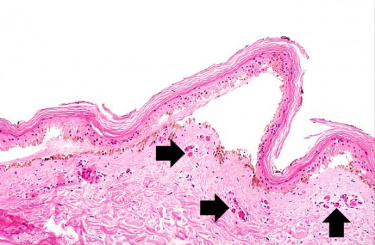 IPLab:Lab 12:Burns - Pathology Education Instructional Resource