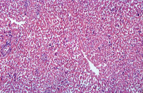 IPLab:Lab 13:Hyaline Membrane Disease - Pathology Education ...