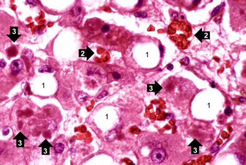 IPLab:Lab 2:Fatty Change and Cirrhosis - Pathology Education ...