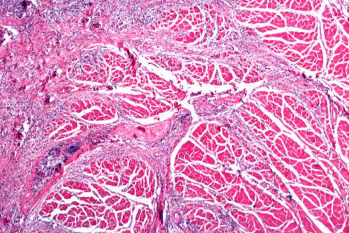 IPLab:Lab 7:Lip SCC - Pathology Education Instructional Resource