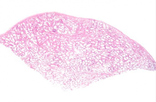 IPLab:Lab 2:Metastatic Calcification - Pathology Education ...