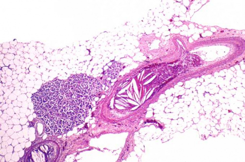 IPLab:Lab 4:Atheromatous Emboli - Pathology Education Instructional ...
